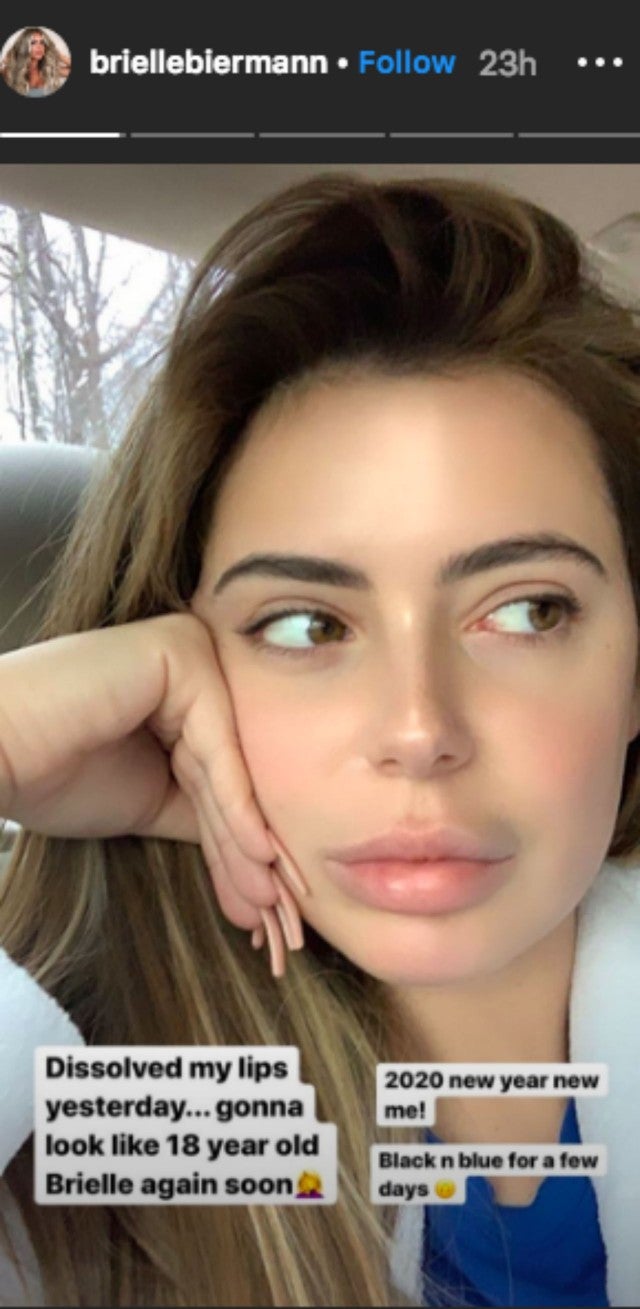 Brielle Biermann's Removing Her Lip Filler Just as Her Ex is Getting ...